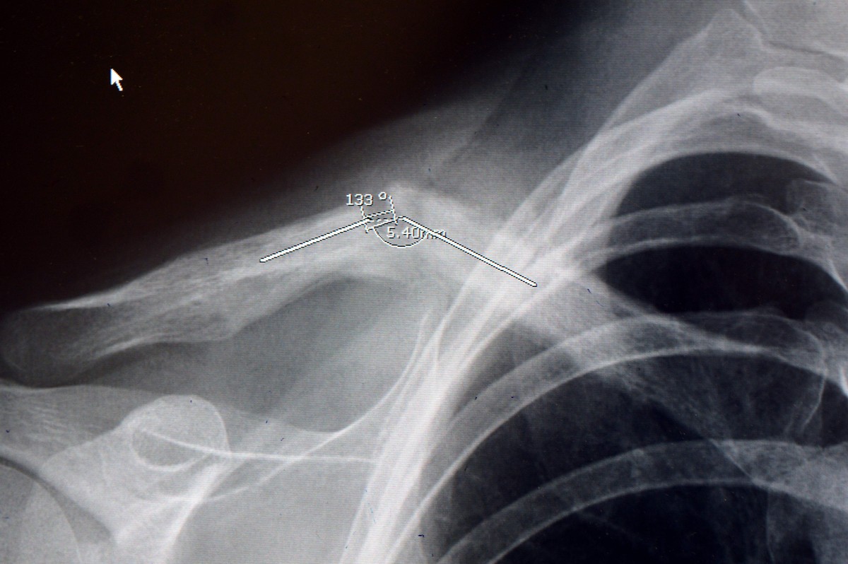 Clavicle Surgery -Update - Moto-Related - Motocross Forums / Message ...