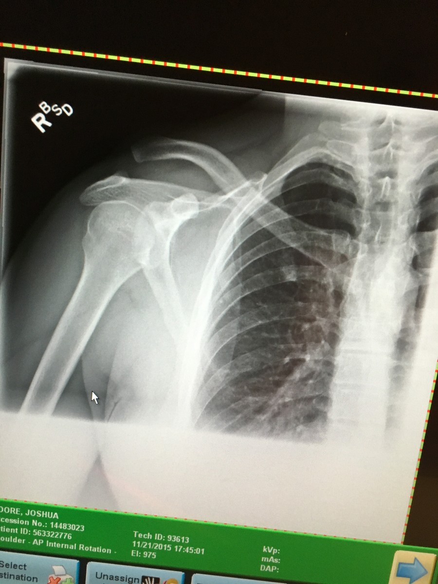 Separated Shoulder Injuries - Moto-Related - Motocross Forums / Message ...