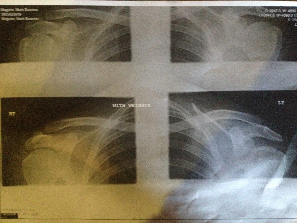 Separated Shoulder Injuries - Moto-Related - Motocross Forums / Message ...
