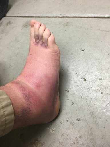 A Mild Ankle Sprain Moto Related Motocross Forums Message Boards