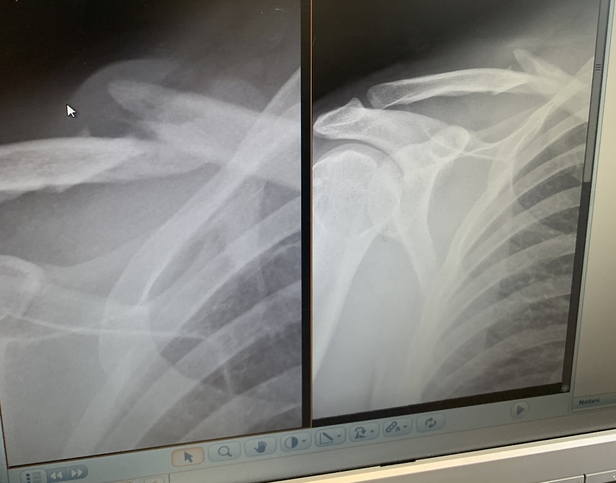 Fractured collarbone non union? - Non-Moto - Motocross Forums / Message ...