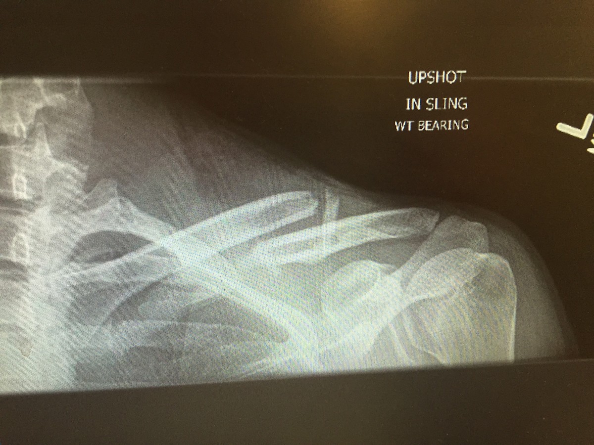 Fractured collarbone non union? - Non-Moto - Motocross Forums / Message ...