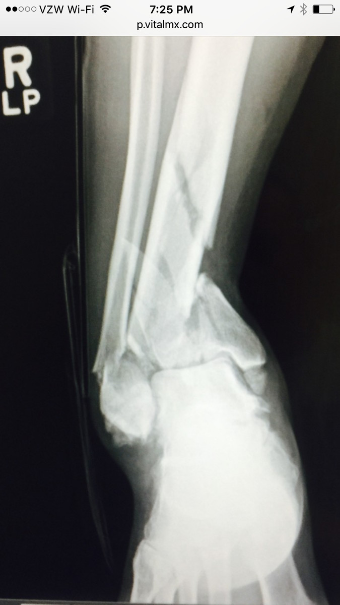 Fused ankle? - Moto-Related - Motocross Forums / Message Boards - Vital MX