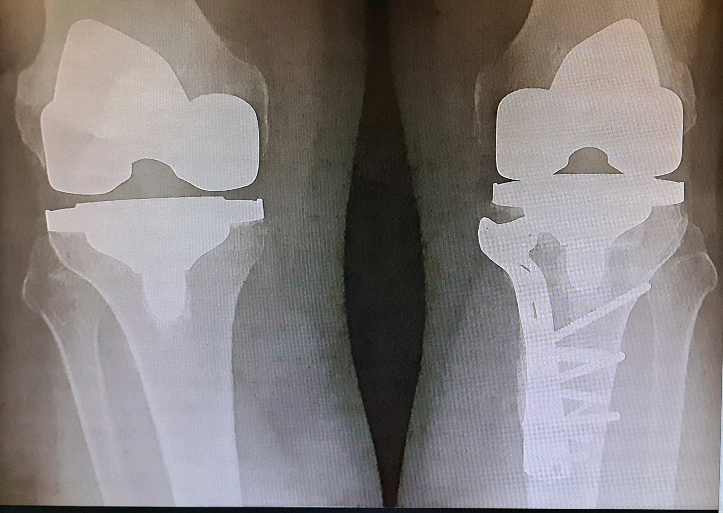 TOTAL KNEE REPLACEMENT QUESTION - Moto-Related - Motocross Forums ...