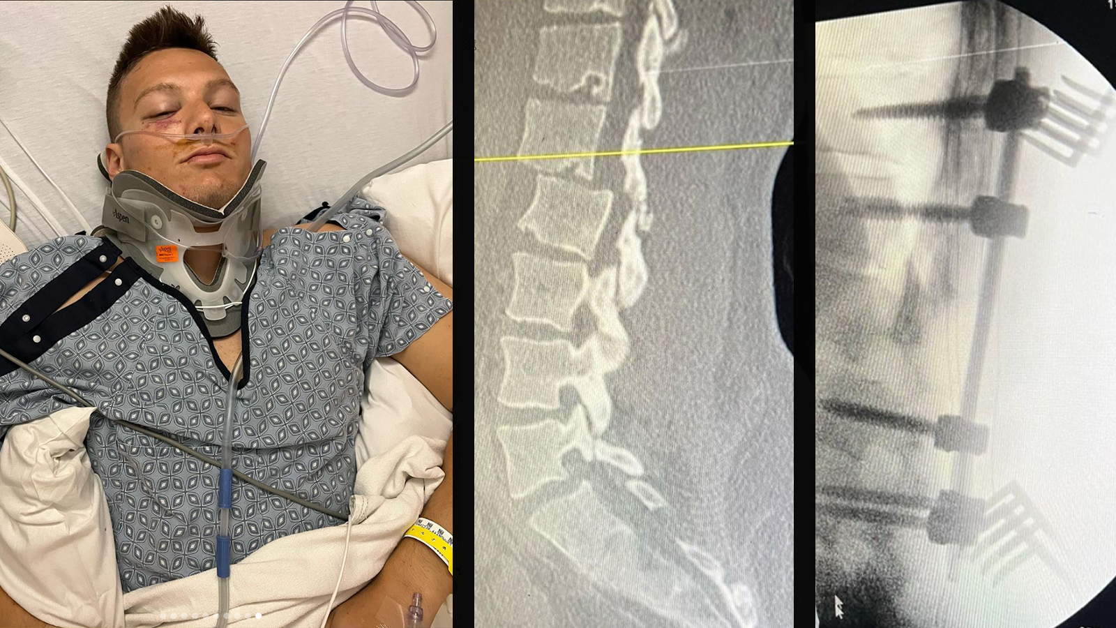 "I'm so Glad I was Knocked Out. My Hip was Out, My Back... I don't ...