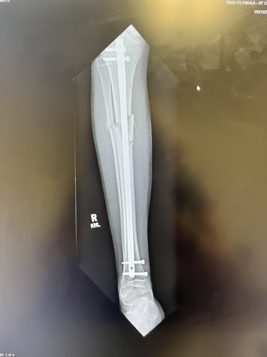 Tibia nail recovery - Moto-Related - Motocross Forums / Message Boards ...